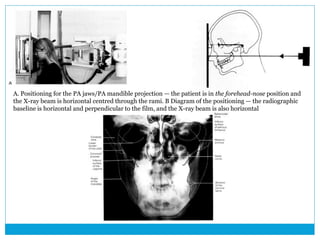 Postero anterior cephalometry | PPTX