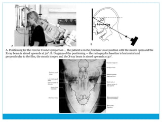 Postero anterior cephalometry | PPTX