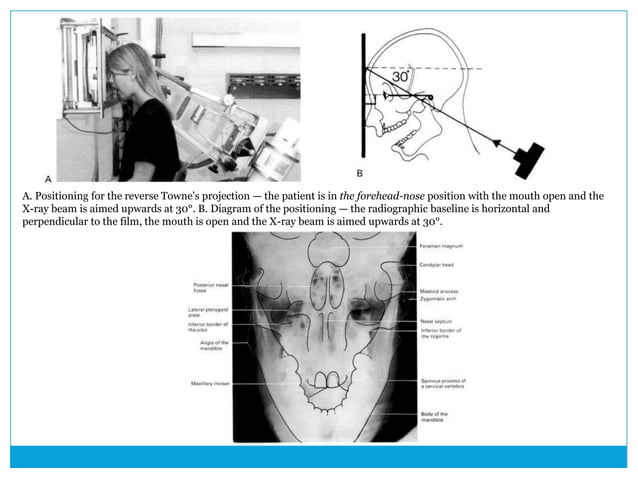 Postero anterior cephalometry | PPTX | Dental Health | Diseases and ...