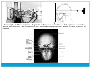 Postero anterior cephalometry | PPTX