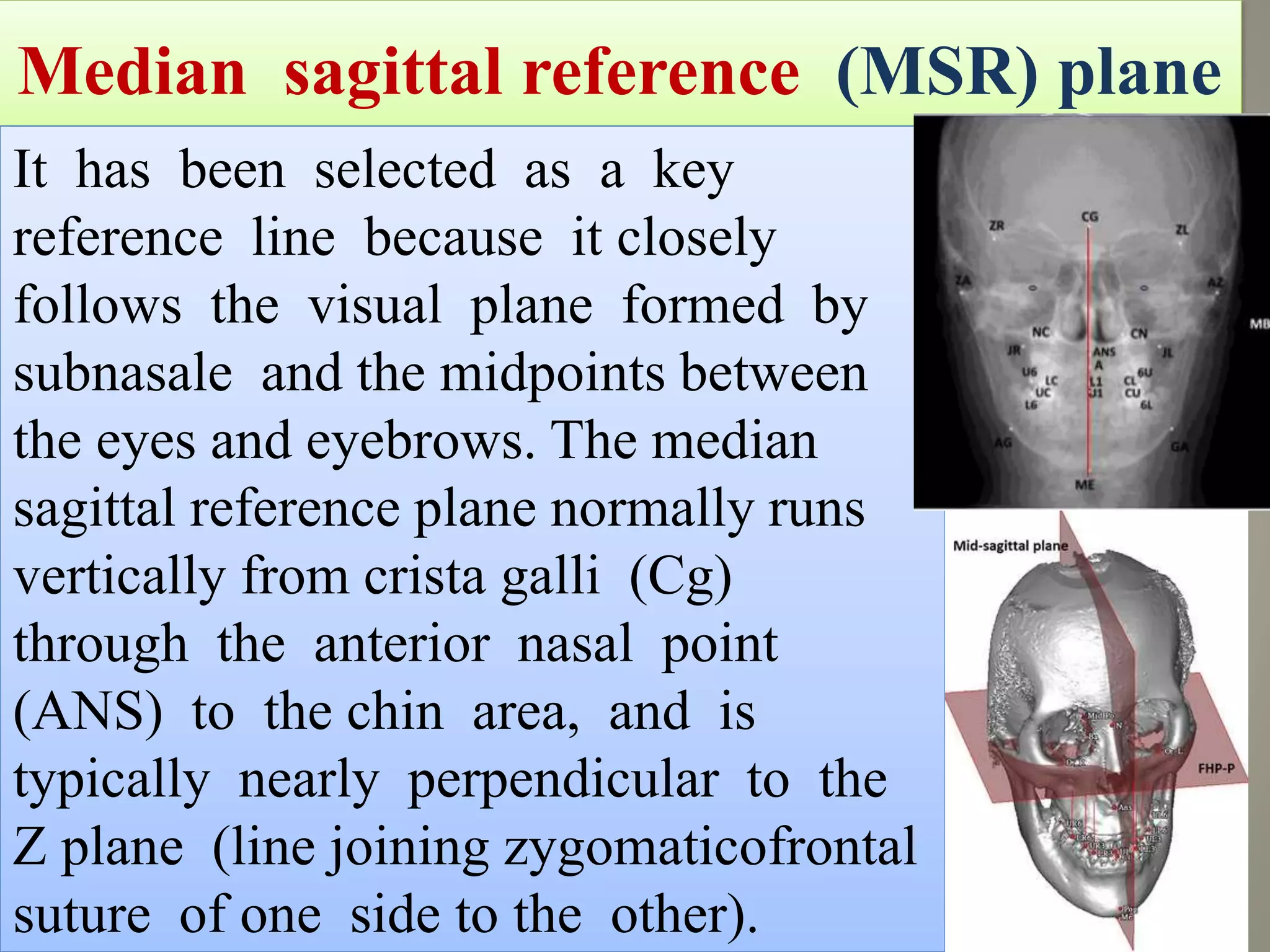 Postero anterior cephalometric _ mansoura university _ Egypt | PPTX