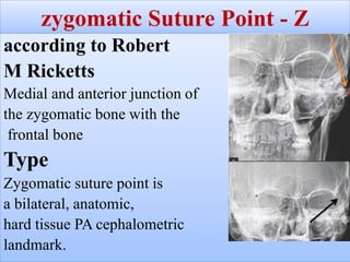 Postero anterior cephalometric _ mansoura university _ Egypt | PPTX