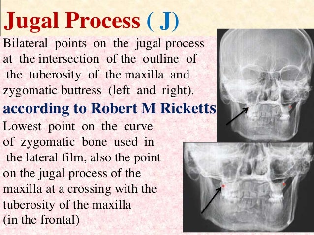Postero anterior cephalometric _ mansoura university _ Egypt