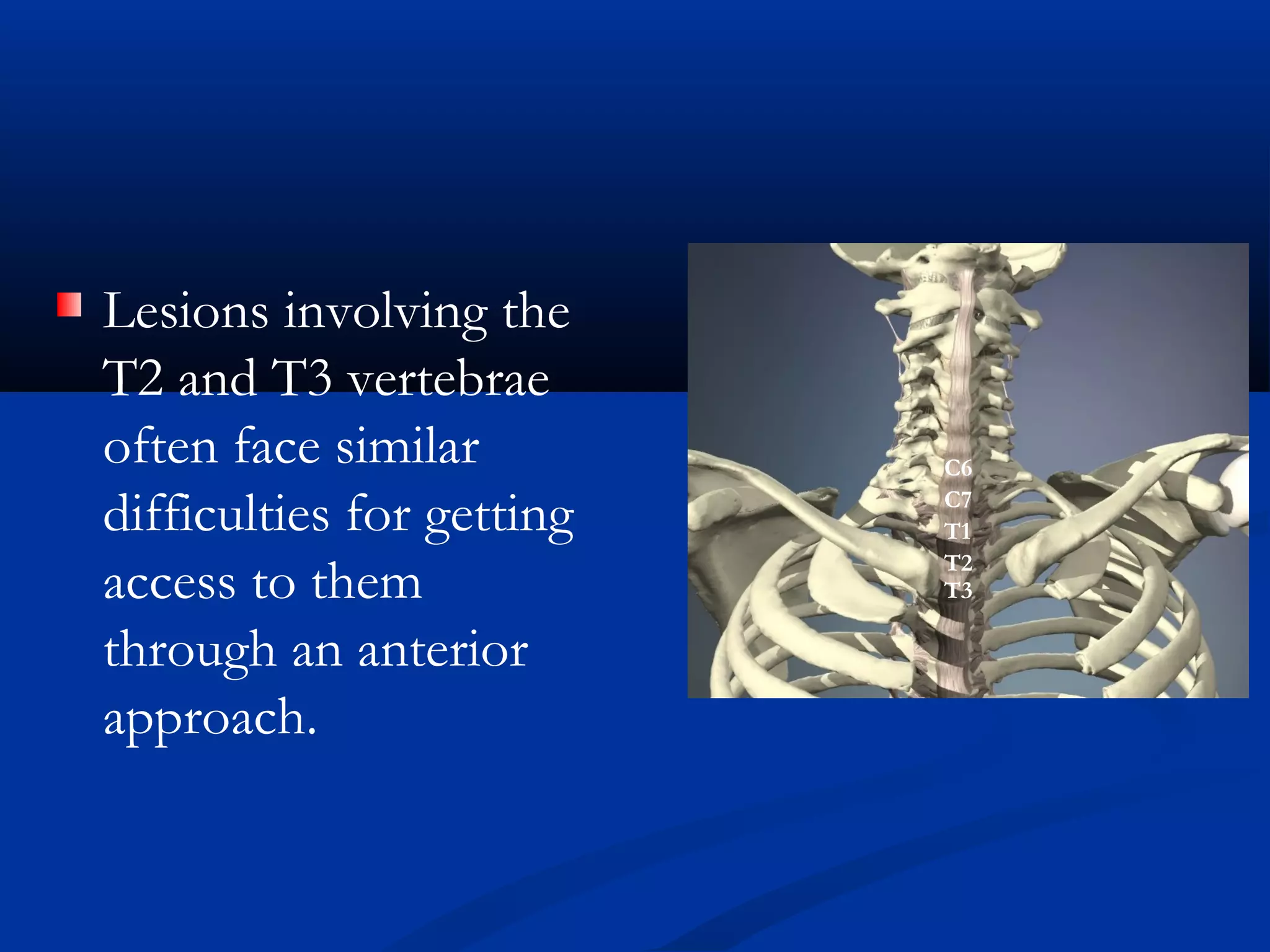 The midline and lateral parascapular extrapleural exposures | PPT