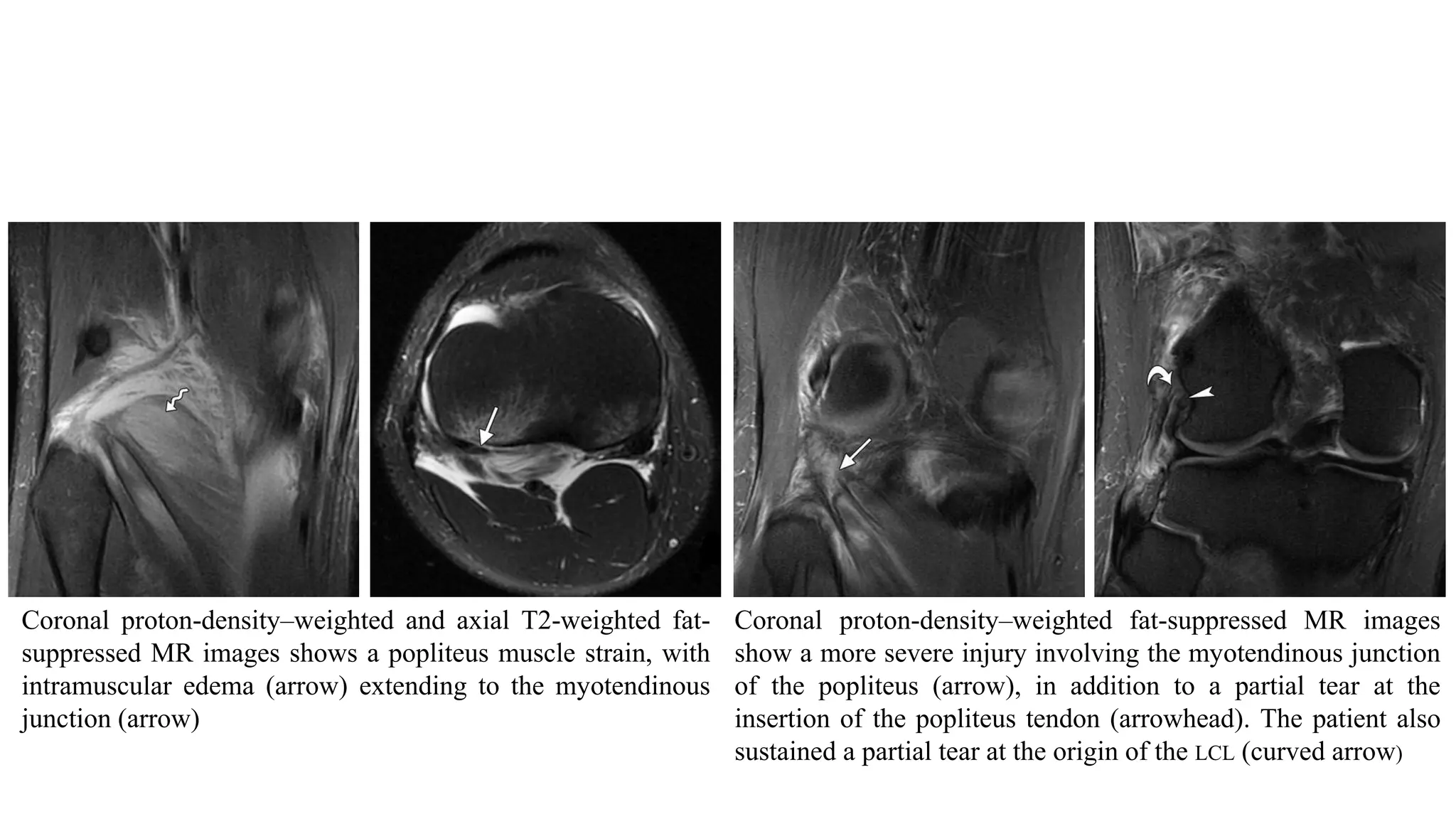 Posterolateral corner knee injuries | PPTX