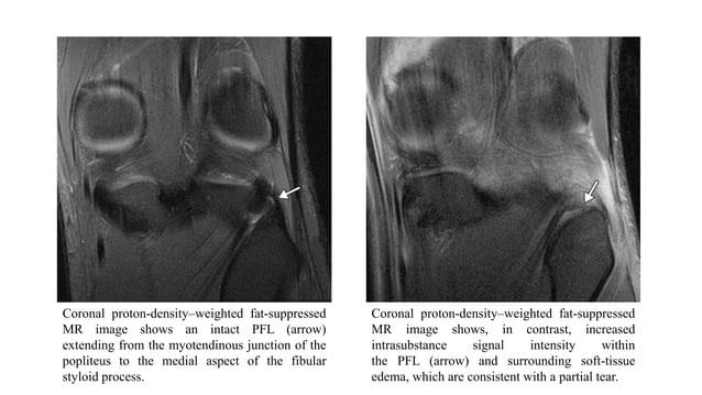 Posterolateral corner knee injuries | PPTX | Death, Injury, or Military ...