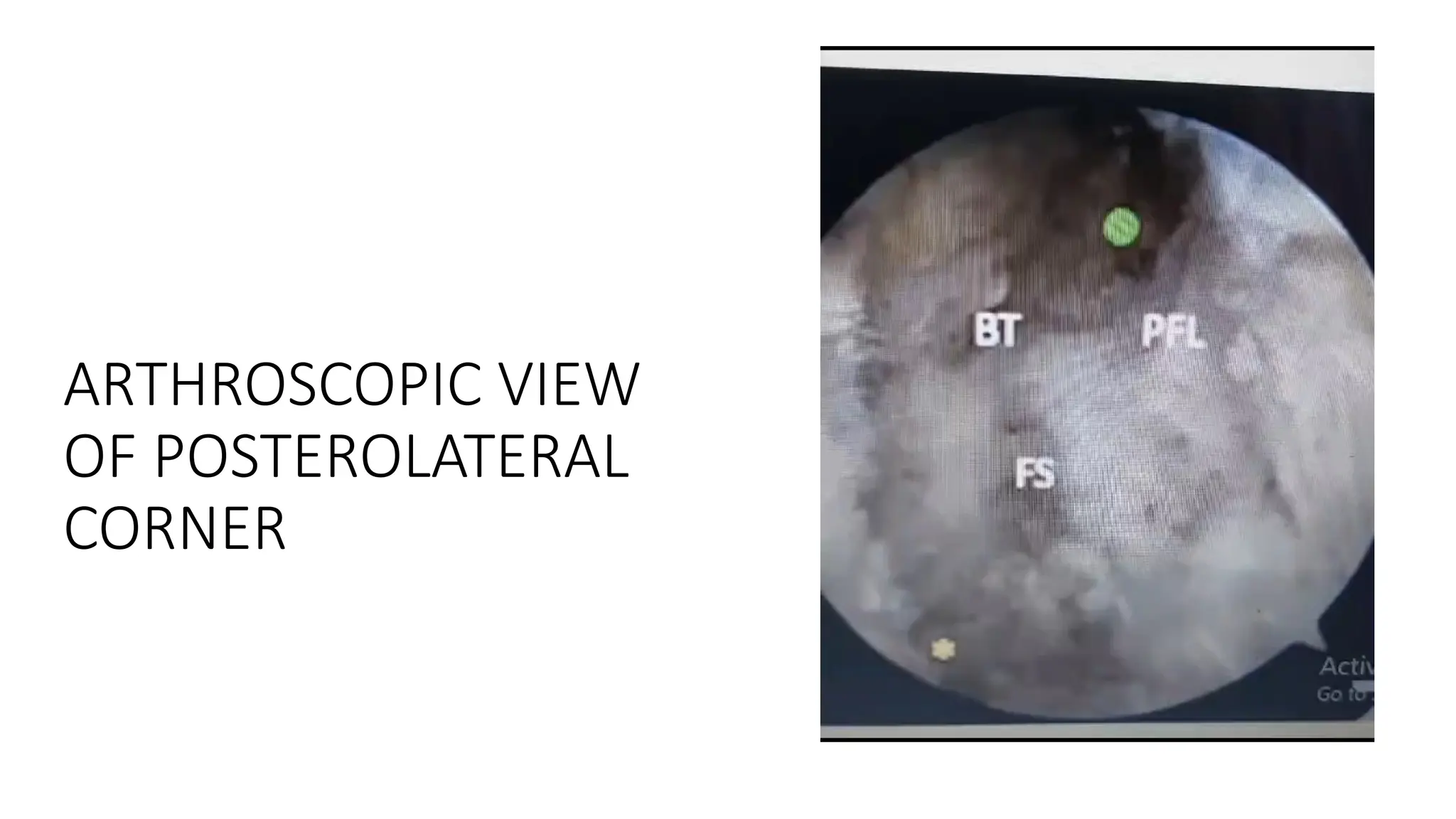 POSTEROLATERAL CORNER INJURY KNEE.pptx