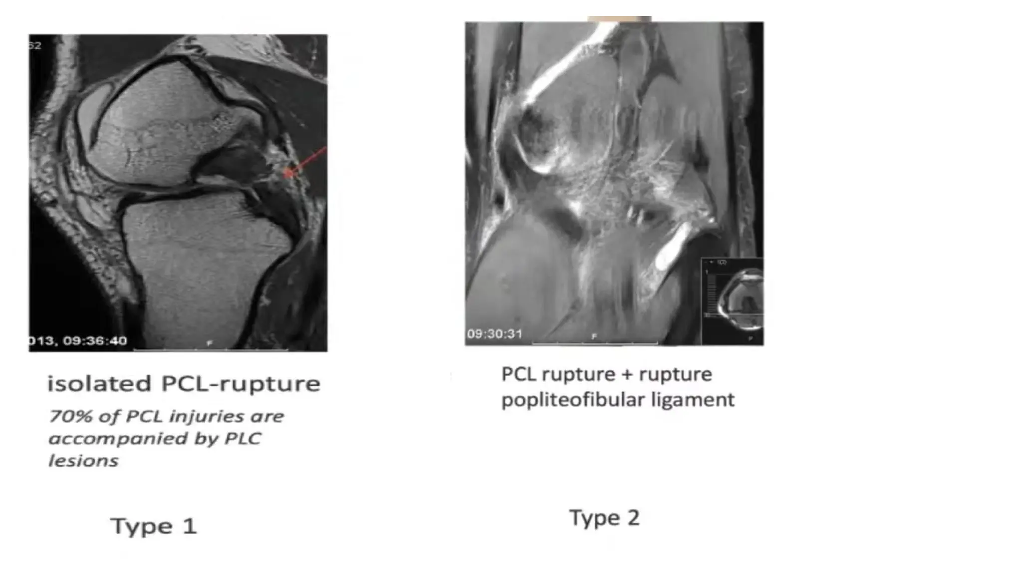 POSTEROLATERAL CORNER INJURY KNEE.pptx