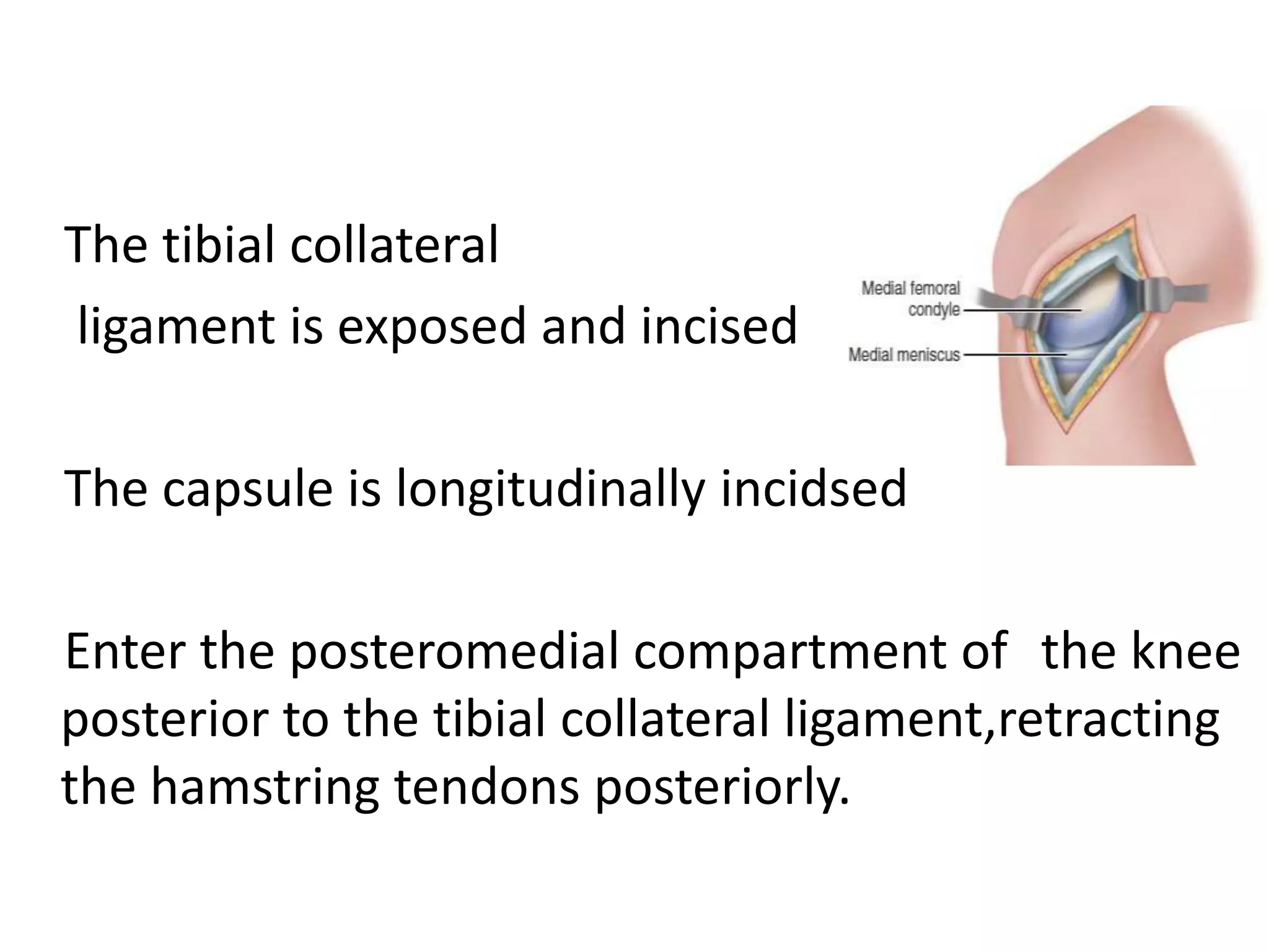 Posteromedial and posterolateral approach to knee | PPTX