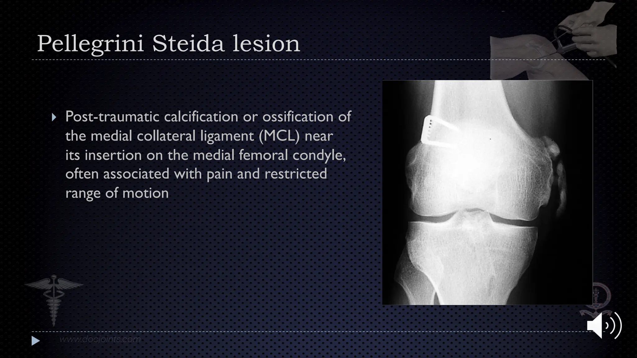 Posteromedial Corner (PMC) and Medial Collateral ligamnet (MCL ...