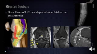 Posteromedial Corner (PMC) and Medial Collateral ligamnet (MCL ...