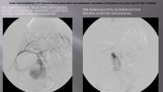 poster on gastric artery pseudoaneurysm embolisation.pptx