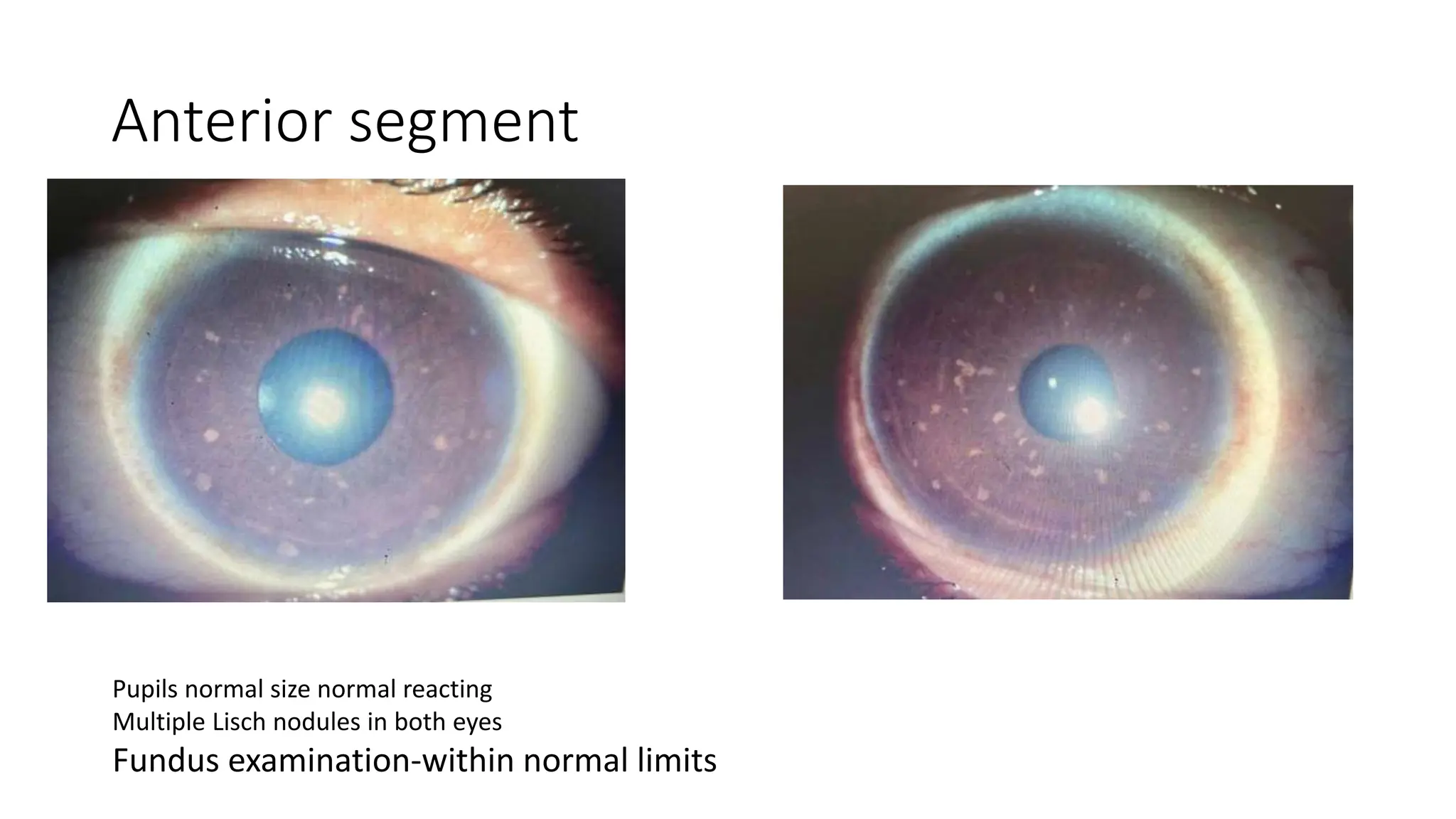 Neurofibromatosis plexiform neurofibroma.pptx