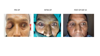 Neurofibromatosis plexiform neurofibroma.pptx