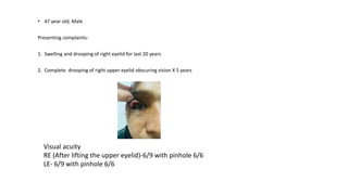 Neurofibromatosis plexiform neurofibroma.pptx