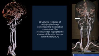 poster ppt brain carotid artery age.pptx
