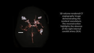poster ppt brain carotid artery age.pptx