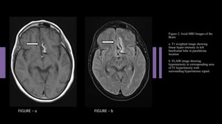 poster ppt brain carotid artery age.pptx
