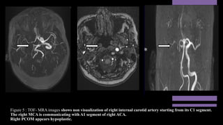 poster ppt brain carotid artery age.pptx