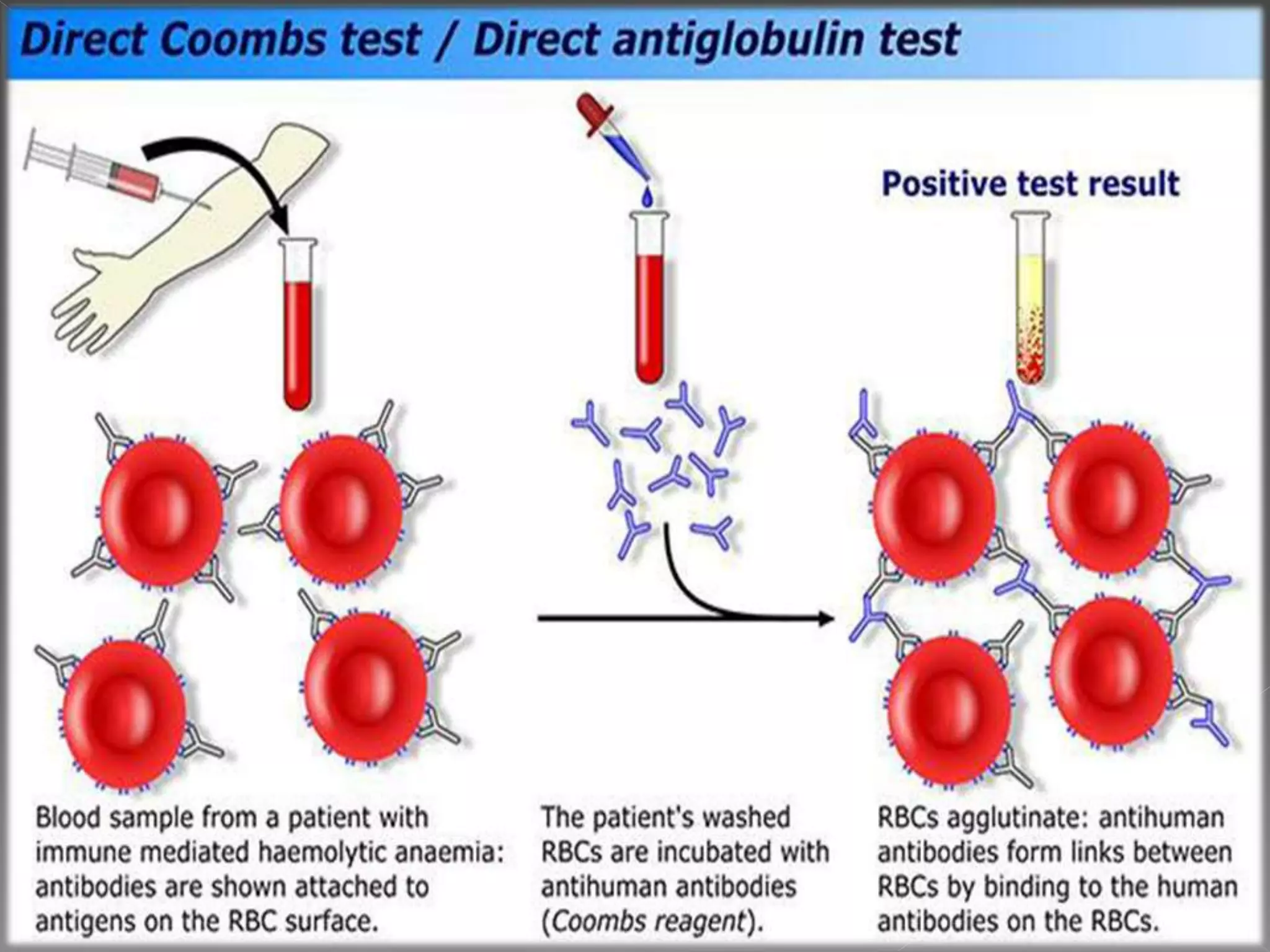 coombs test | PPTX