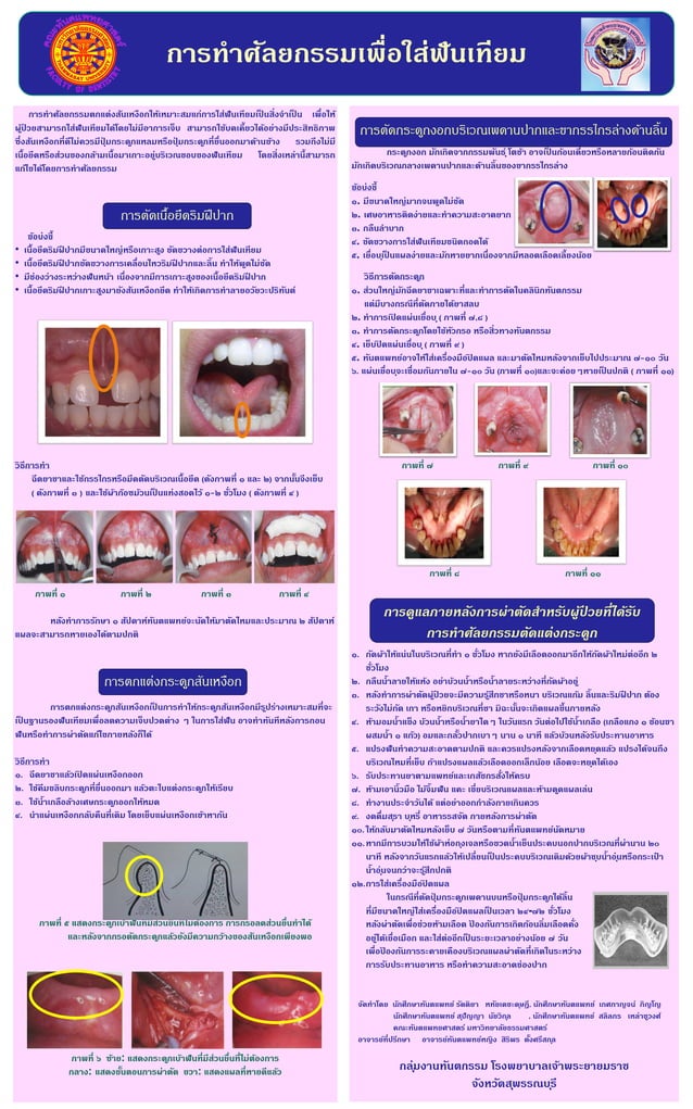 Poster ฟันเทียมถอดได้ rooj | PDF