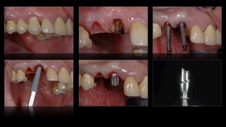 Immediate post estractive Implant | PPT