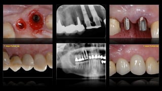 Immediate post estractive Implant | KEY