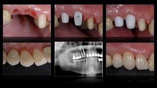 Immediate post estractive Implant | KEY