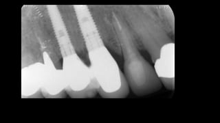 Immediate post estractive Implant | KEY