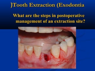 Post extraction care | PPT