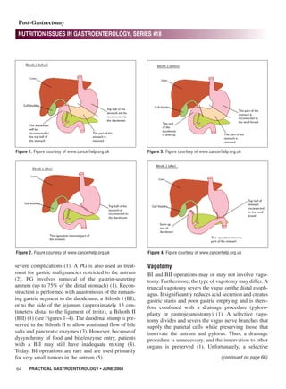 Post gastrectomy | PDF