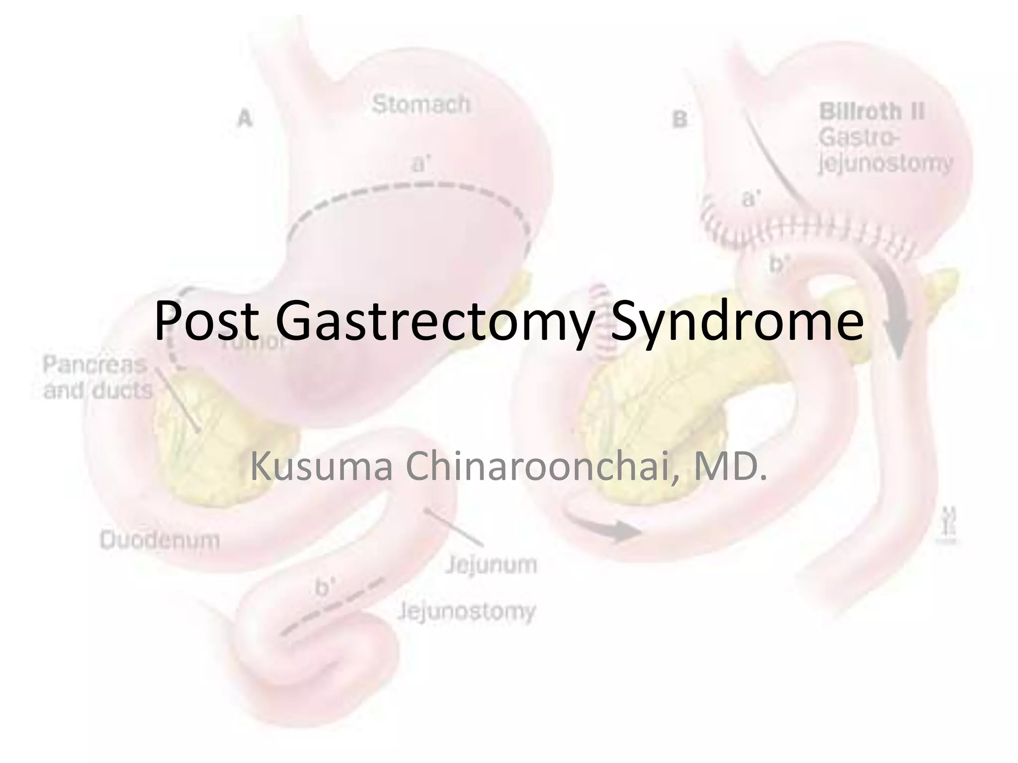 Post Gastrectomy Syndrome | PPTX
