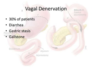 Post Gastrectomy Syndrome | PPTX