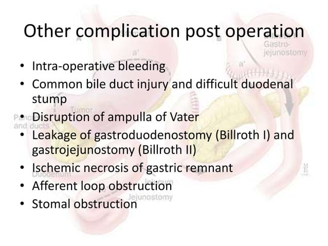 Post Gastrectomy Syndrome | PPTX | Digestive Disorders | Diseases and ...