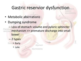 Post Gastrectomy Syndrome | PPTX