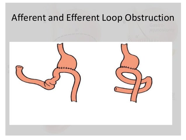 Post Gastrectomy Syndrome