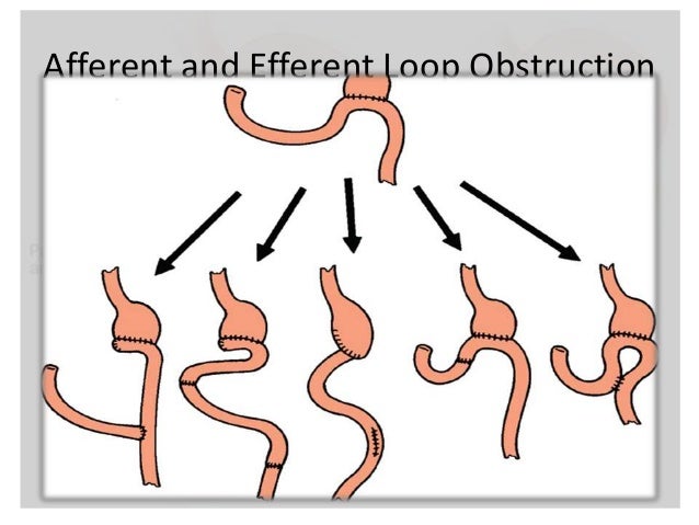 Post Gastrectomy Syndrome