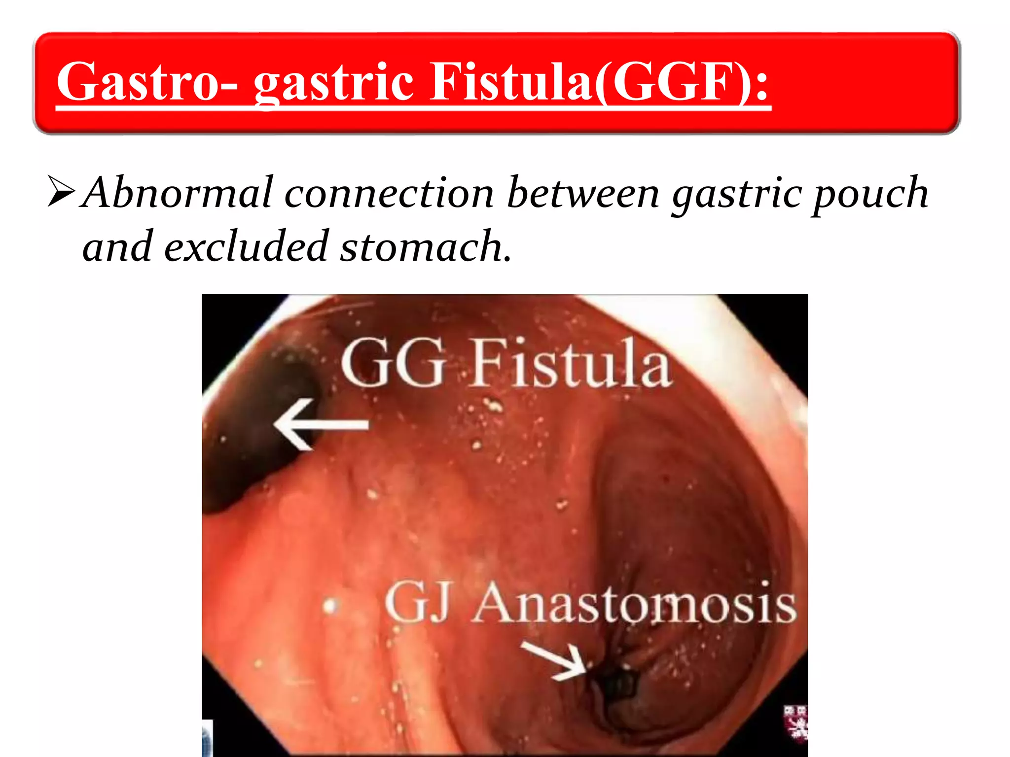 Postgastrectomysyndrome | PPTX