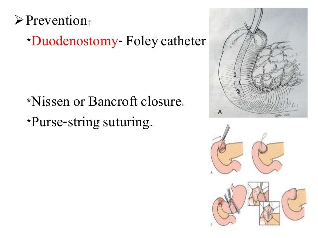 Postgastrectomysyndrome