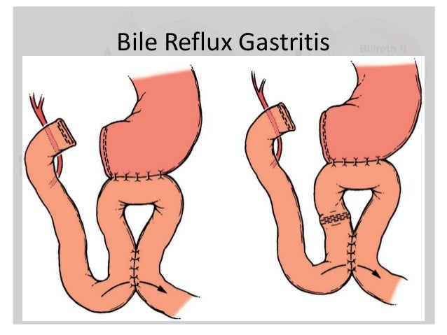 Postgastrectomysyndrome