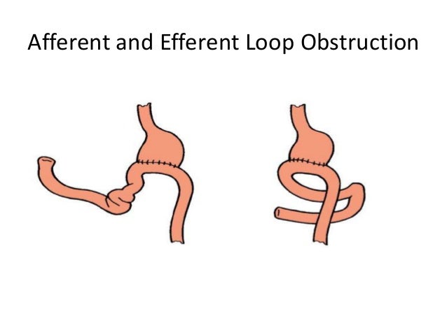 Postgastrectomysyndrome