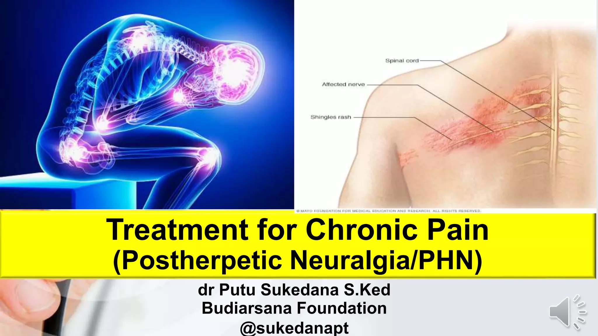 Postherpetic Neuralgia.pptx