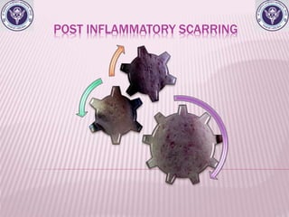 Acne scar presentation | PPTX