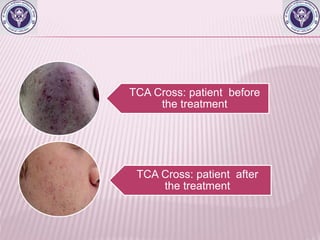 Acne scar presentation | PPTX