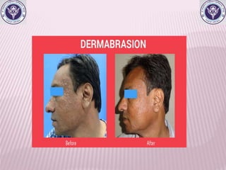 Acne scar presentation | PPTX