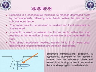 Acne scar presentation | PPTX