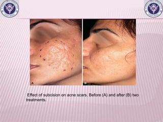 Acne scar presentation | PPTX