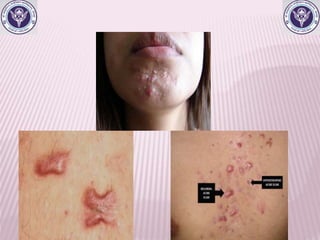 Acne scar presentation | PPTX