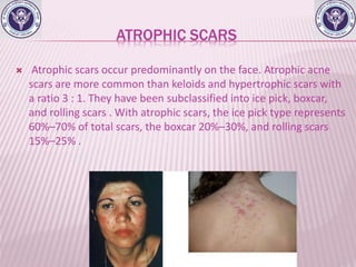 Acne scar presentation | PPTX