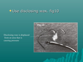 Post Denture insertion complaints | PPT